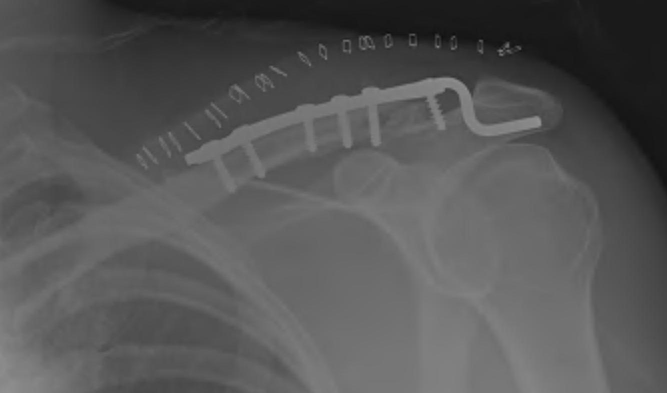 Lateral Clavicle Fracture | The Bone School