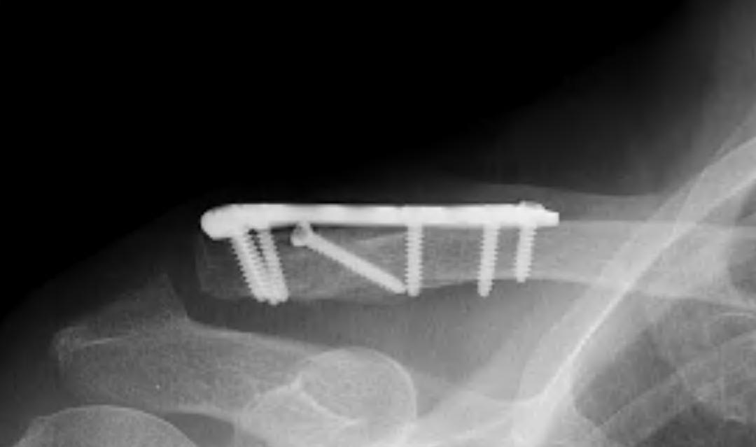 Lateral Clavicle Fracture | The Bone School