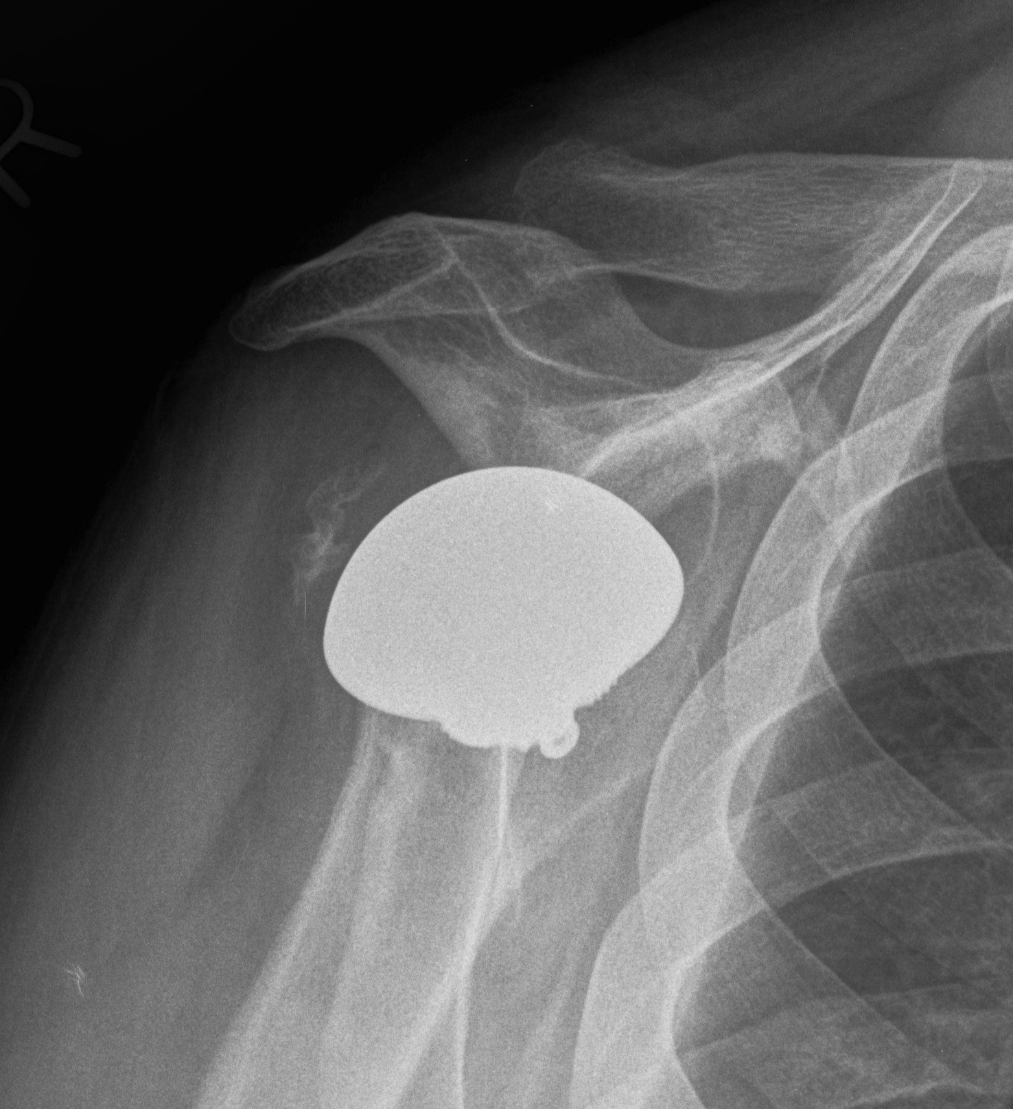 Chronic Locked Anterior Dislocation | The Bone School