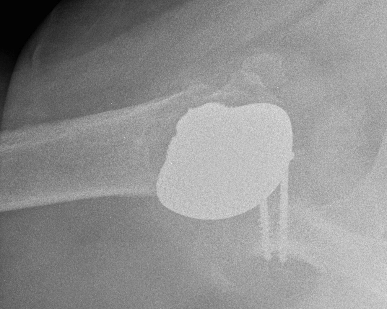 Chronic Locked Anterior Dislocation | The Bone School