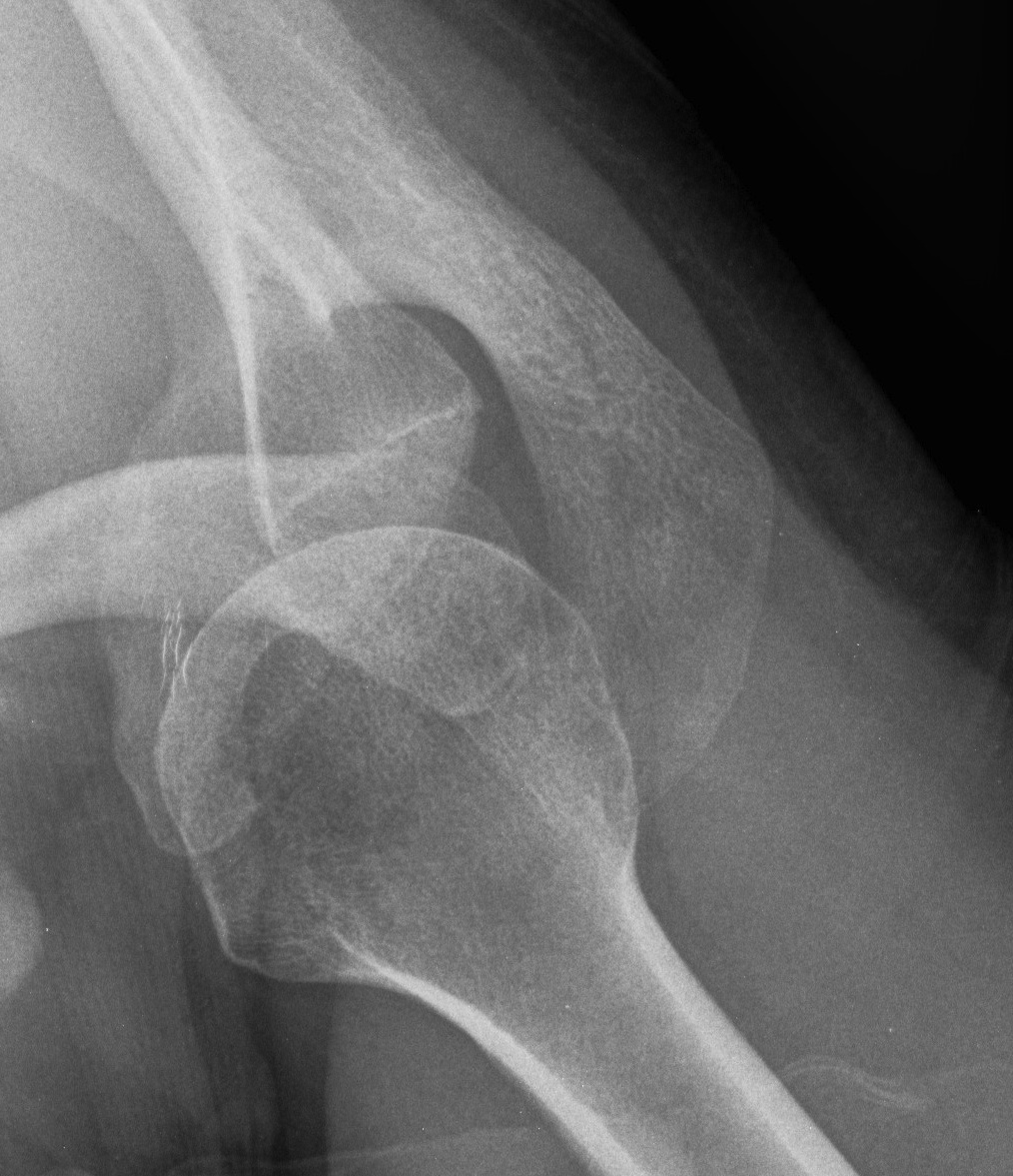 Locked Glenohumeral Dislocation | The Bone School