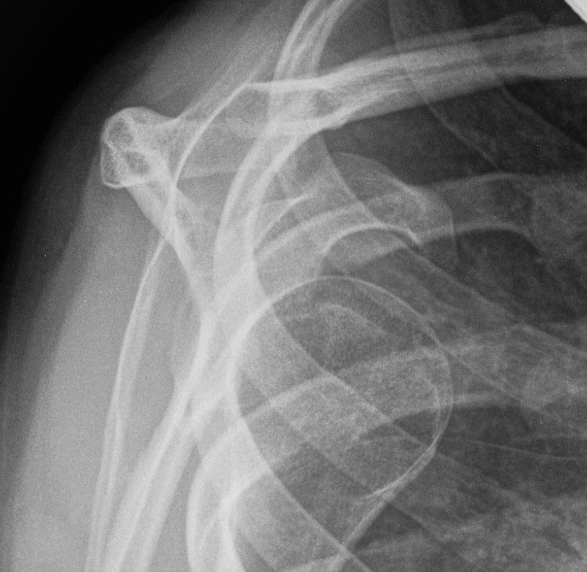 Locked Glenohumeral Dislocation | The Bone School