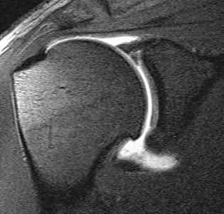 SLAP tear | The Bone School