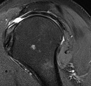 Rotator cuff tendinopathy | The Bone School