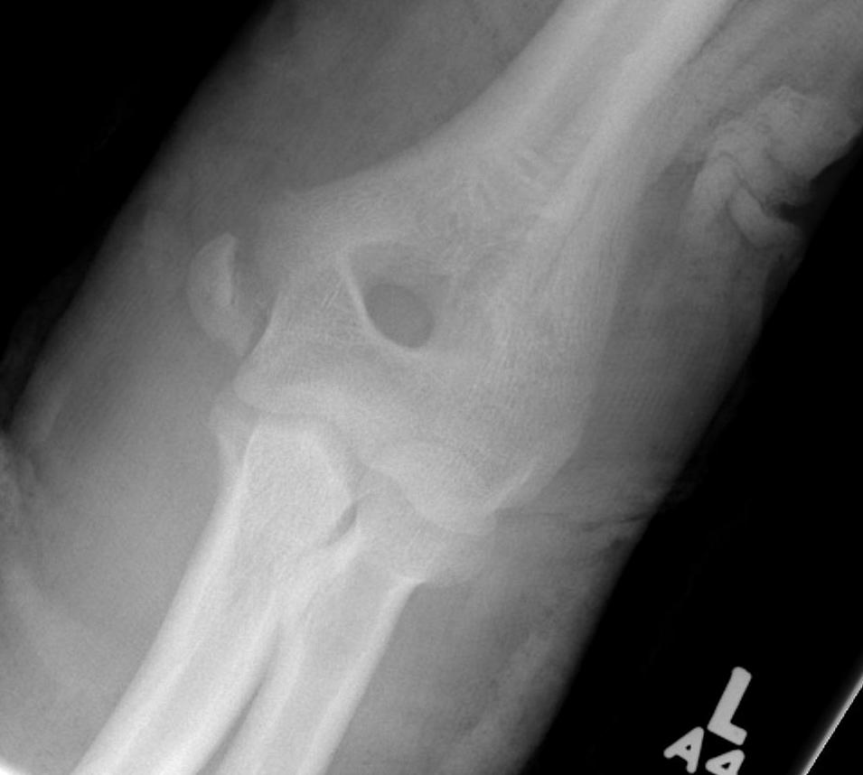 Fracture Of Medial Epicondyle Of Humerus