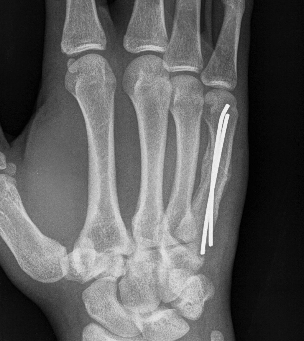 Metacarpal Fractures | The Bone School