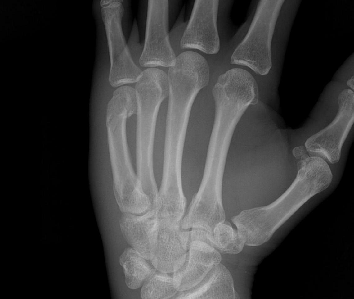 Metacarpal Fractures | The Bone School