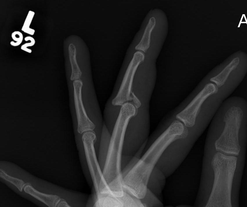 PIPJ dislocations | The Bone School