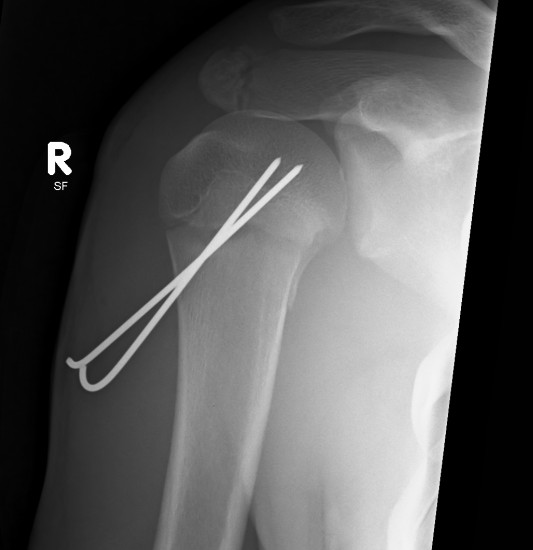 Proximal Humeral Fractures | The Bone School