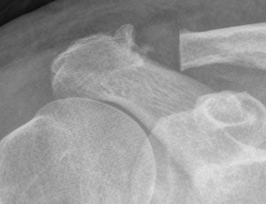 ACJ Osteoarthritis | The Bone School