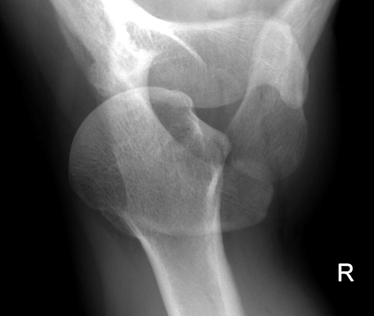 Acute Posterior Dislocation | The Bone School