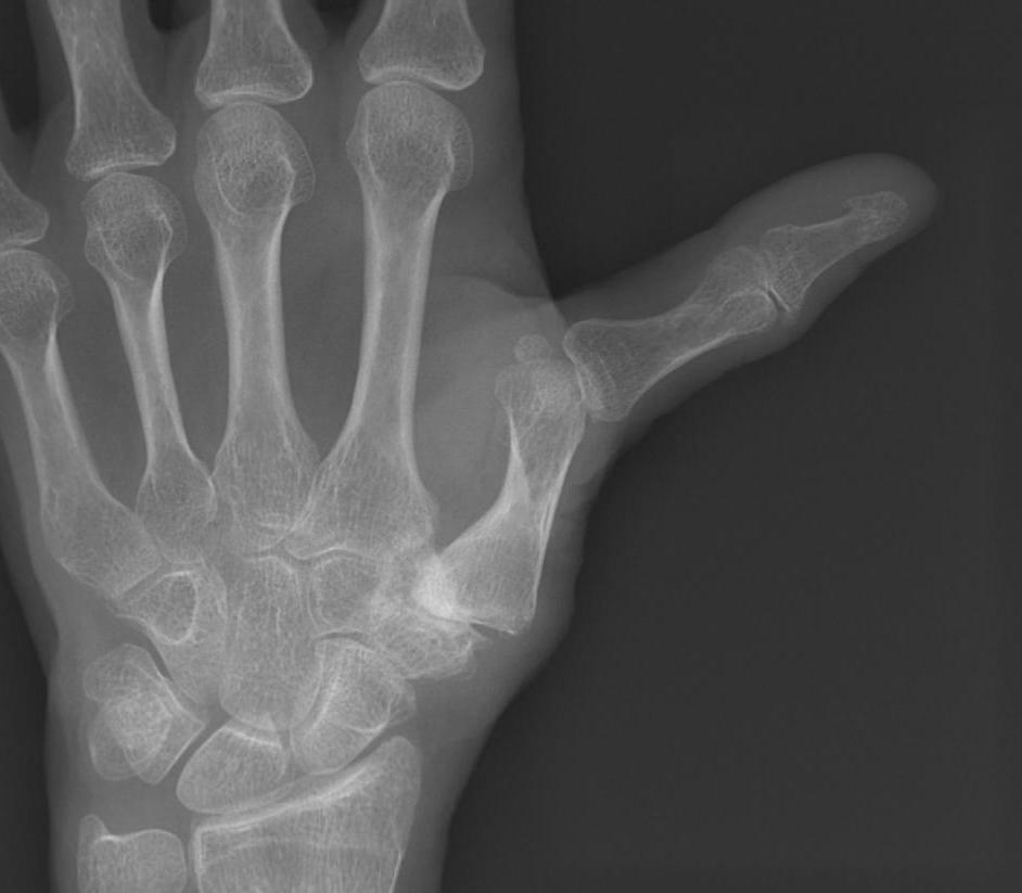 Rheumatoid Thumb | The Bone School