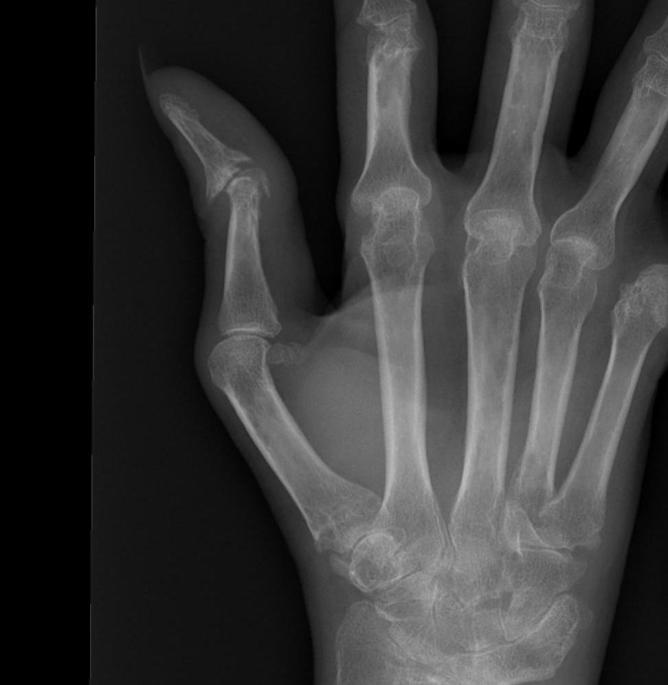 Rheumatoid Thumb | The Bone School