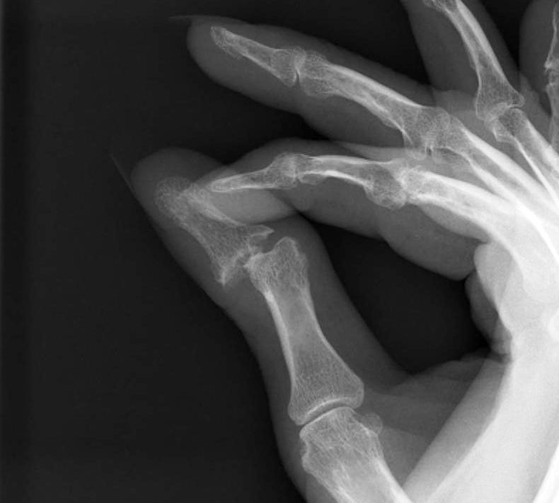 Rheumatoid Thumb | The Bone School