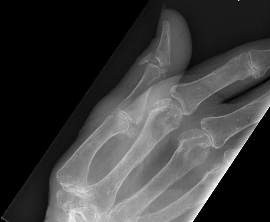 Rheumatoid Thumb | The Bone School
