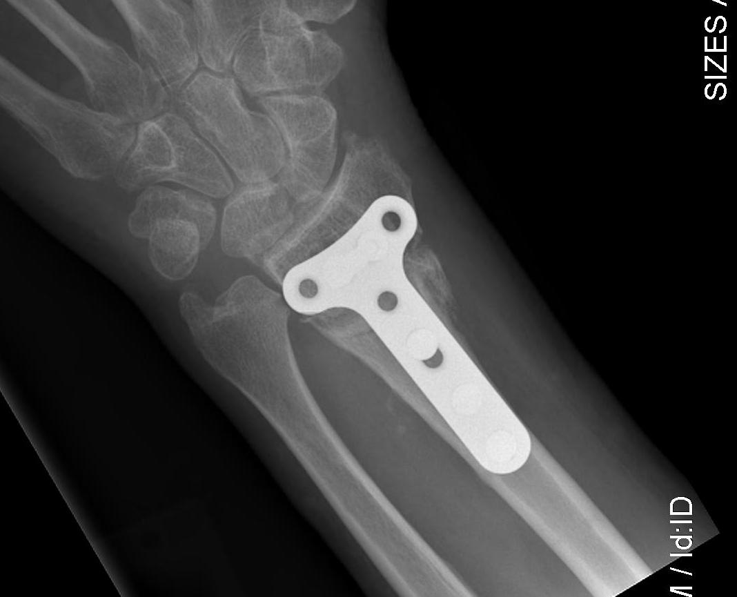 Distal radius malunion | The Bone School