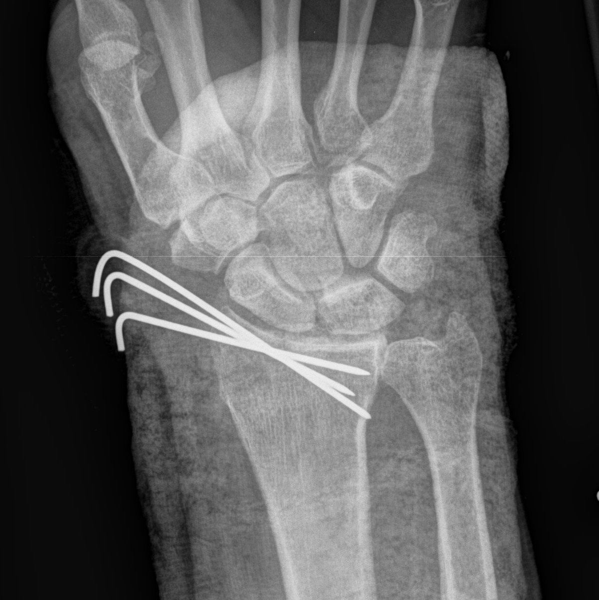 Distal Radius Fracture | The Bone School