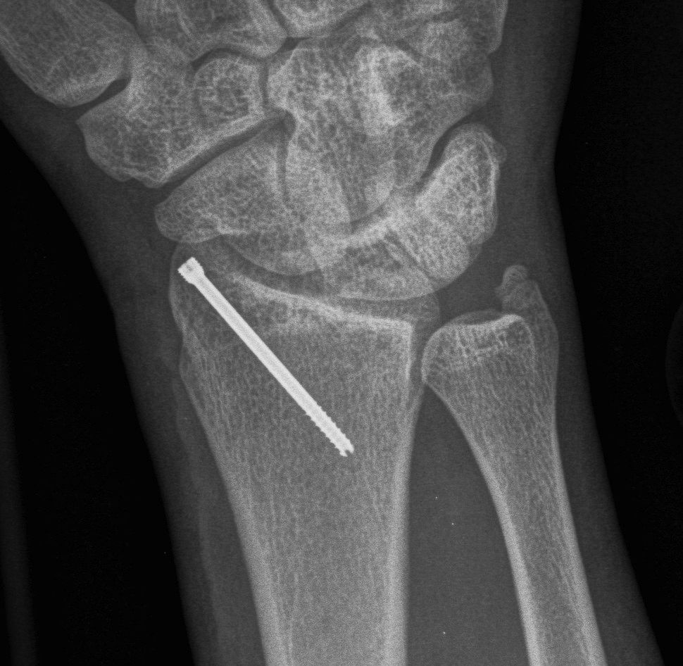 Distal Radius Fracture | The Bone School