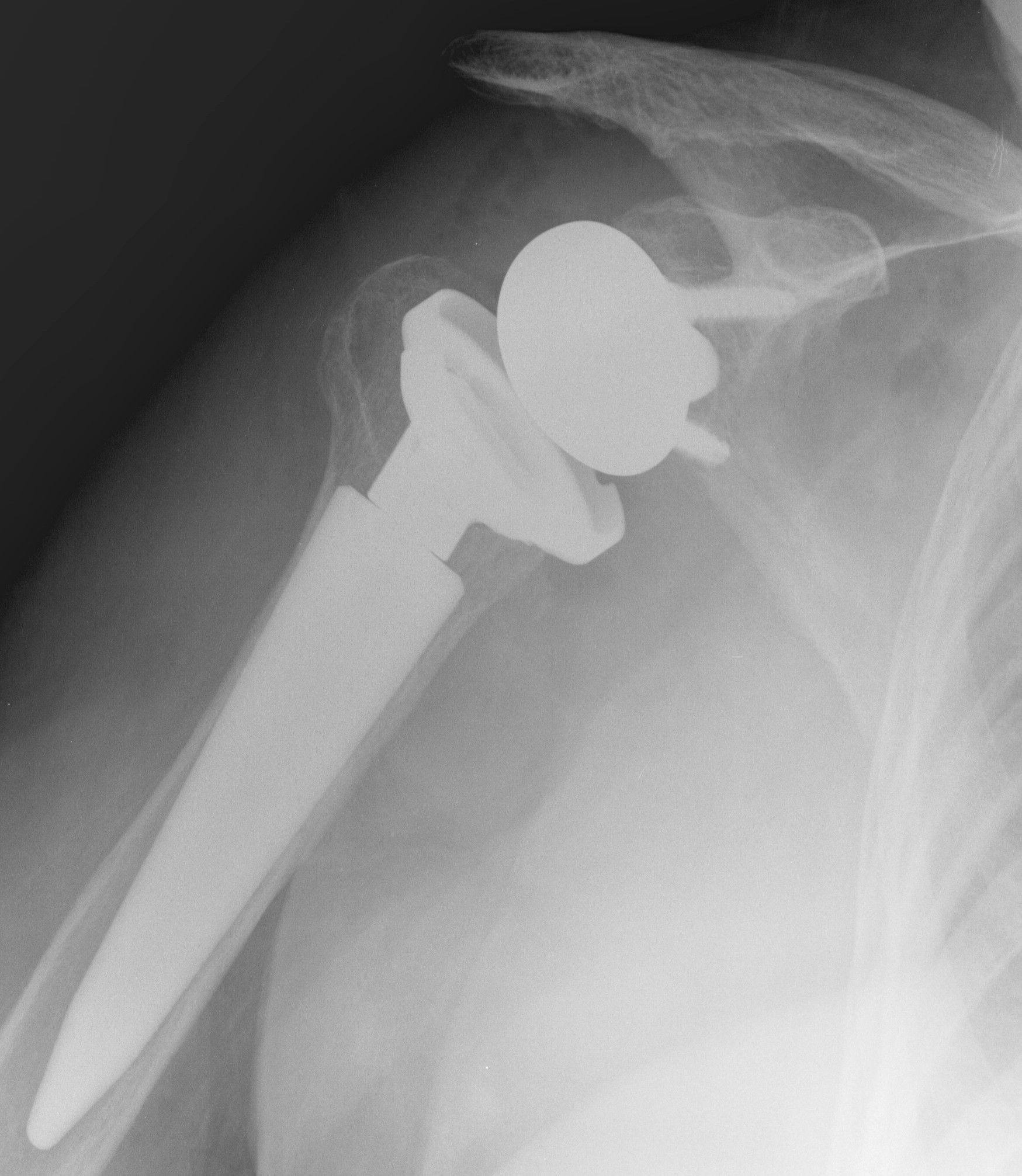 Cuff Tear Arthropathy | The Bone School