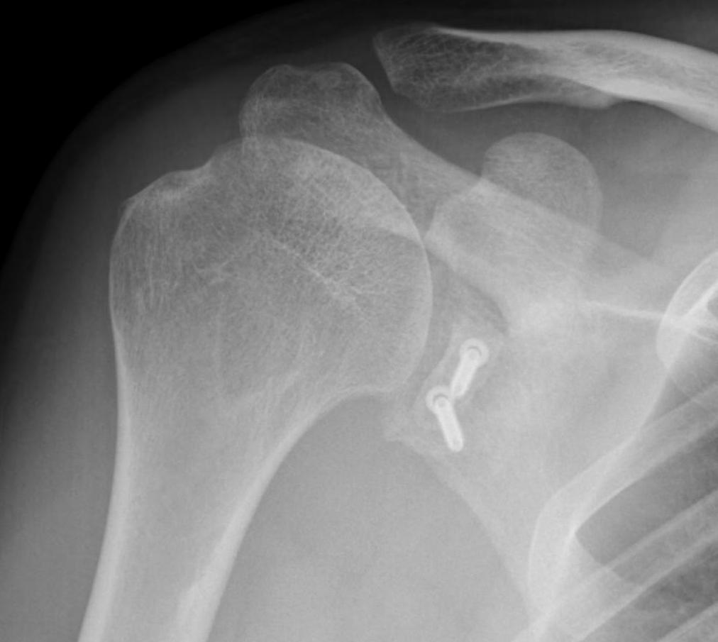Revision Stabilisation | The Bone School