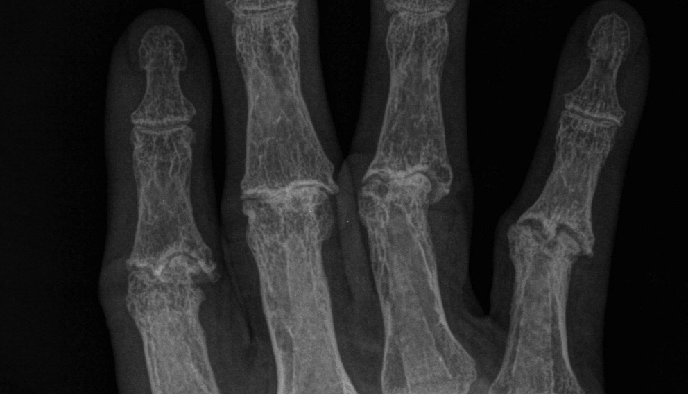 Rheumatoid Fingers | The Bone School