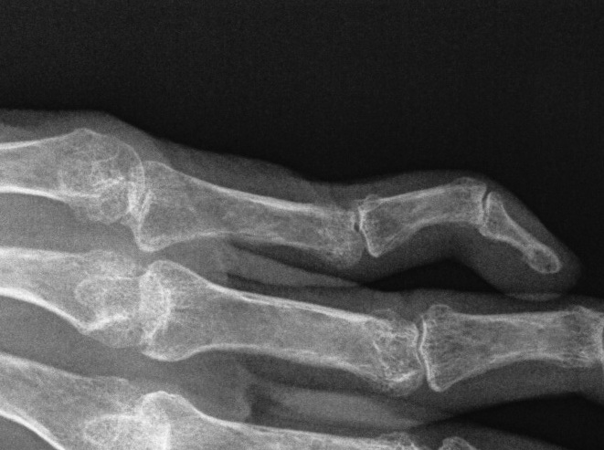 Rheumatoid Fingers | The Bone School