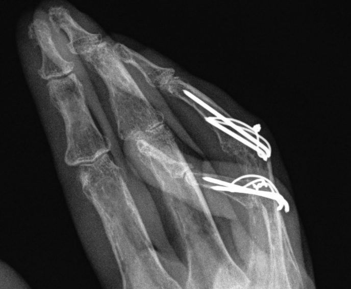 Rheumatoid Fingers | The Bone School