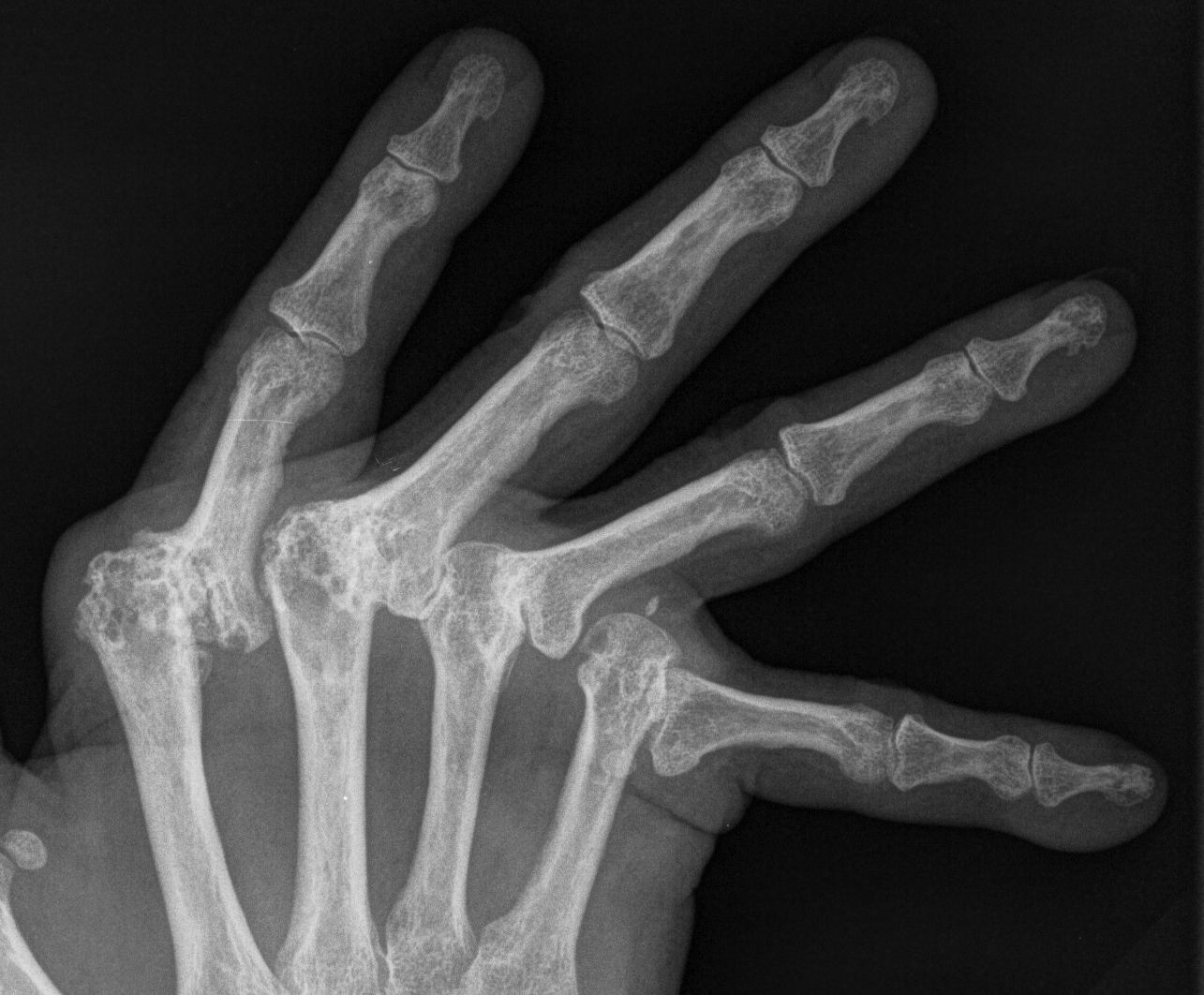 Rheumatoid MCPJ | The Bone School