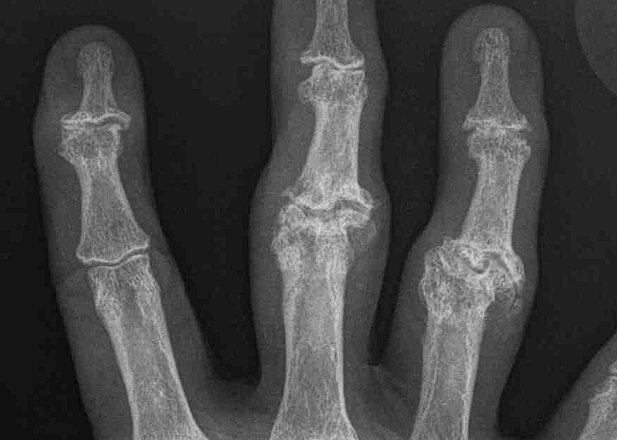 Rheumatoid Fingers | The Bone School