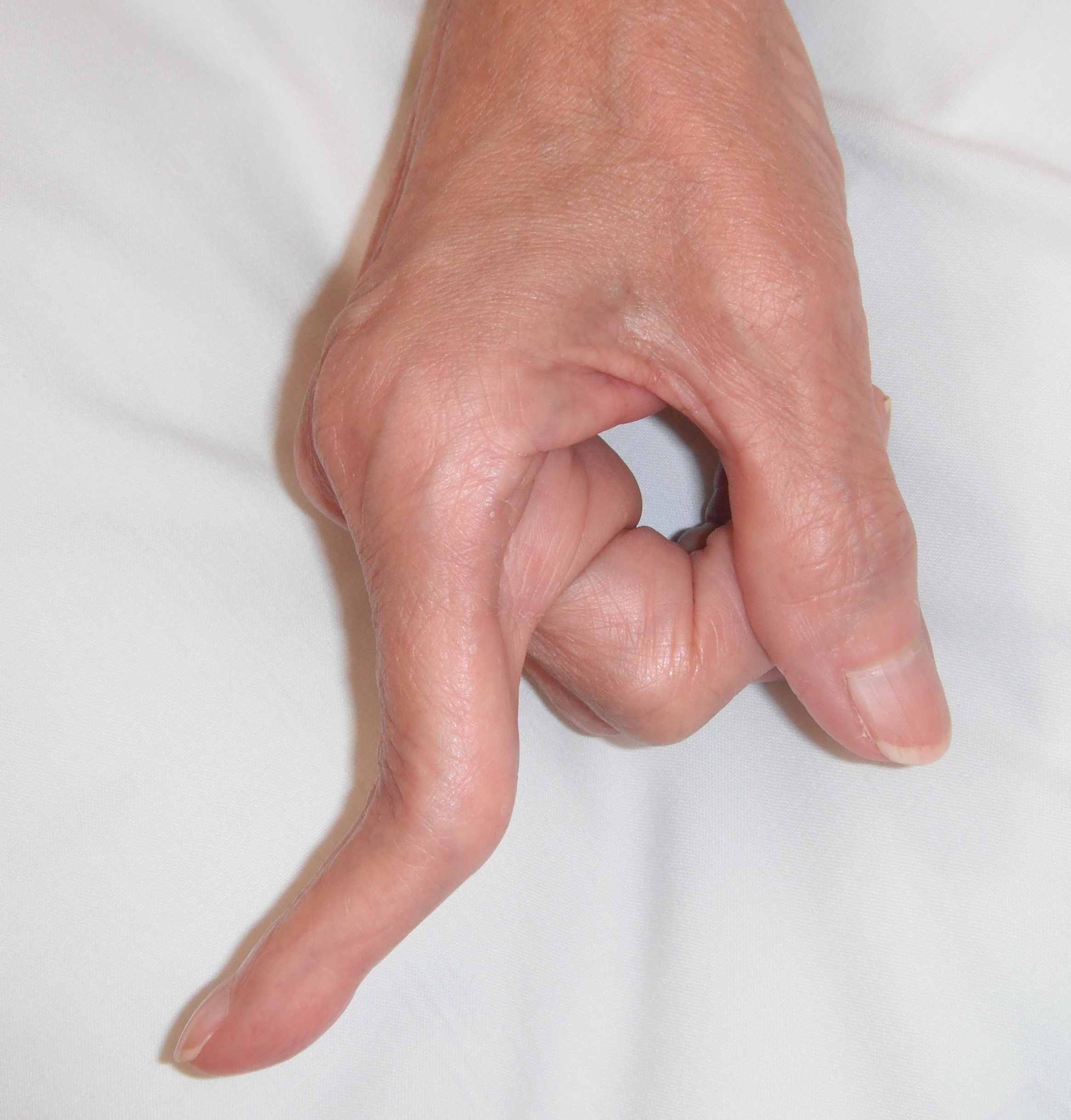 Thumb Extension Deformity