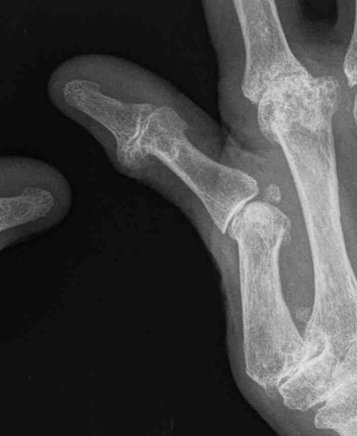 Rheumatoid Thumb | The Bone School