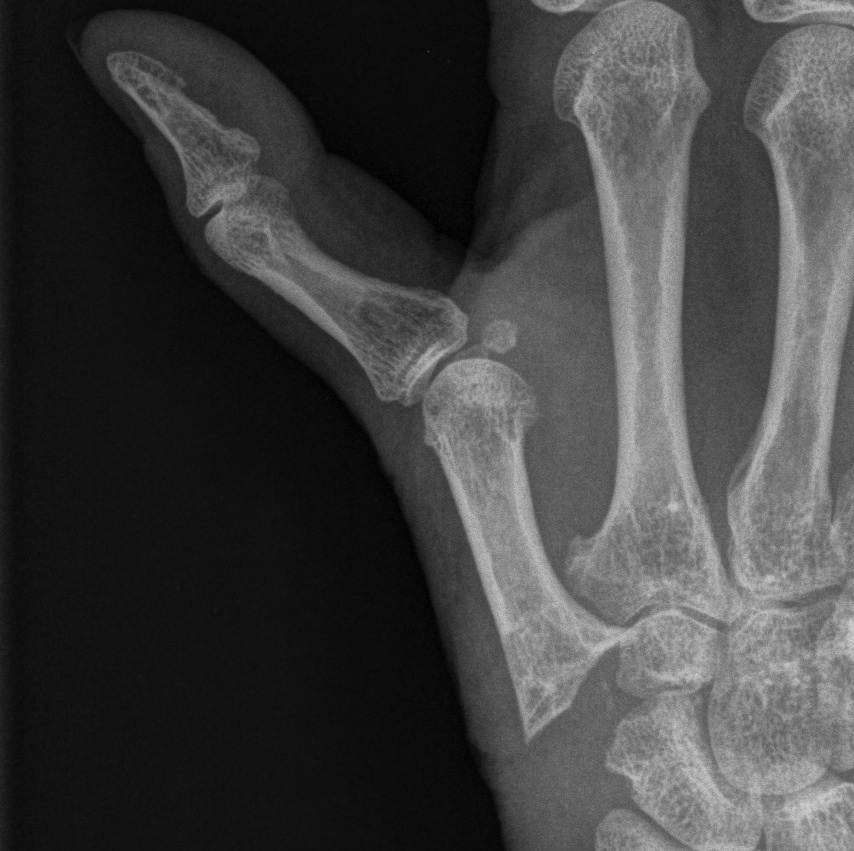 Rheumatoid Thumb | The Bone School