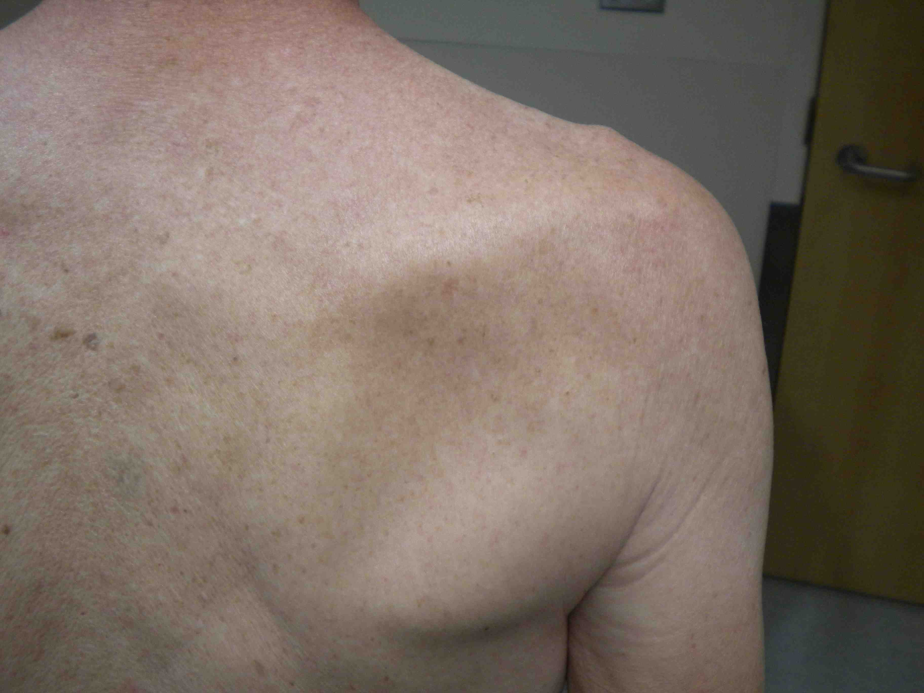 Shoulder | The Bone School