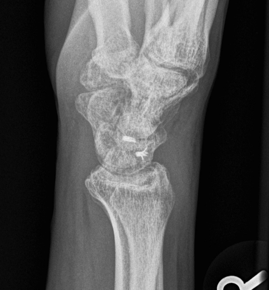 Scapholunate ligament injury | The Bone School