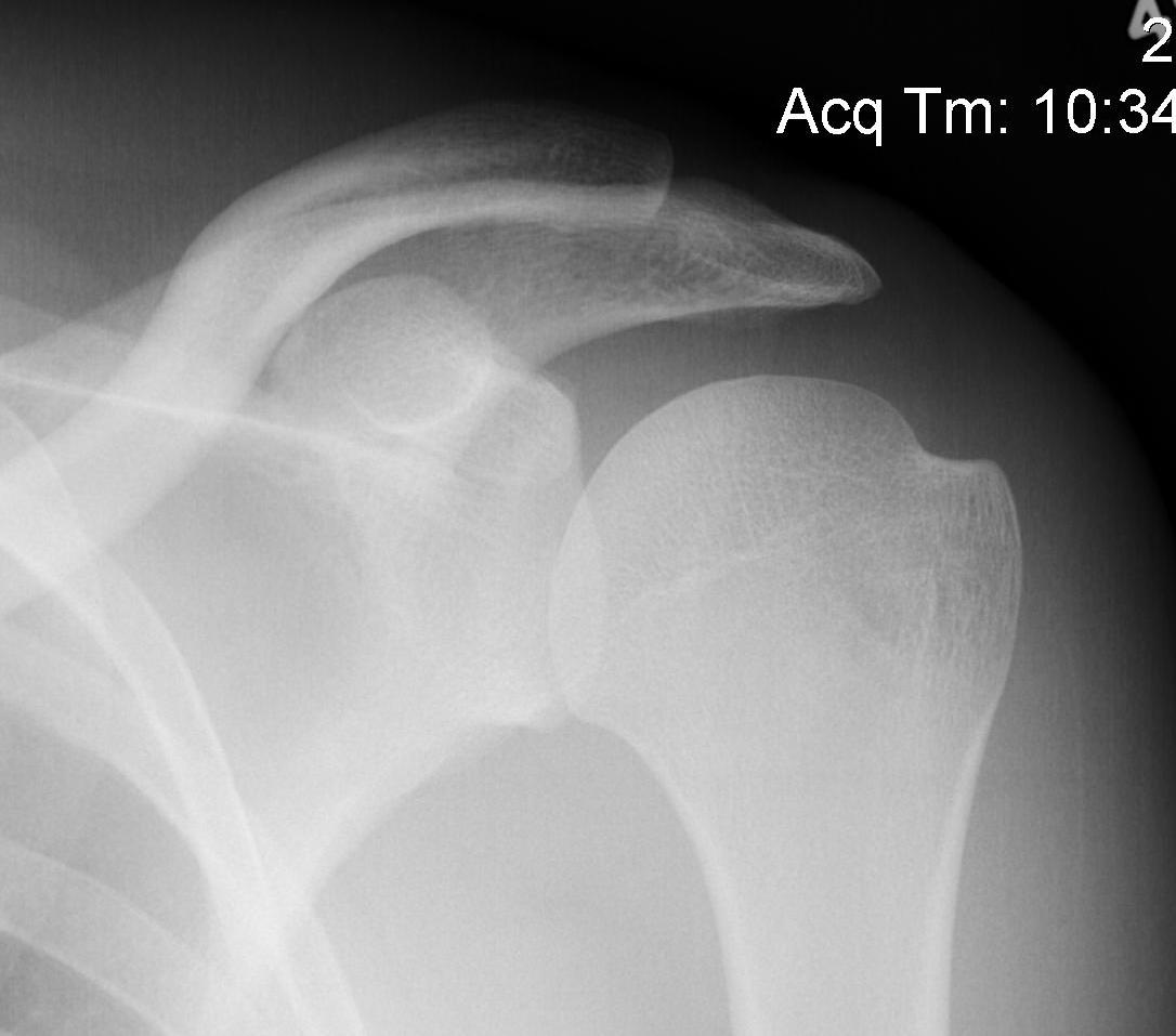 Xray Shoulder Normal