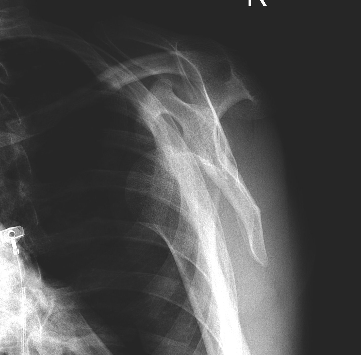 Acute Anterior Dislocation | The Bone School