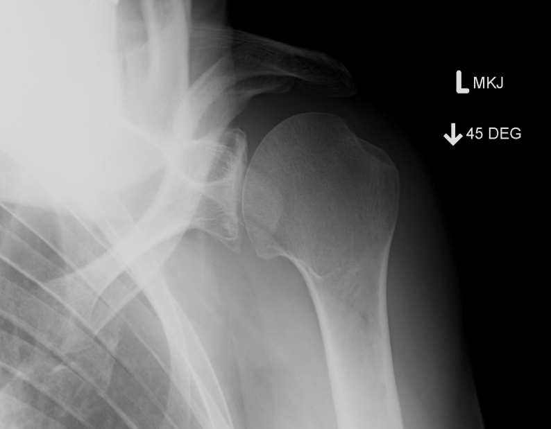 Shoulder Xrays | The Bone School