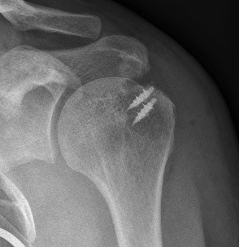 Arthroscopic Acromioplasty | The Bone School