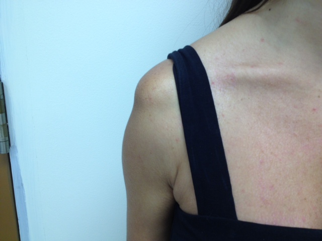 allograft reconstruction | The Bone School