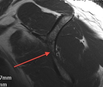 Suprascapular Notch Mri