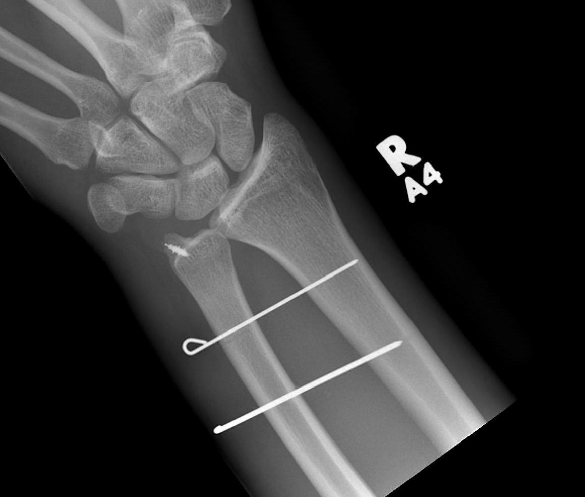 DRUJ Instability | The Bone School