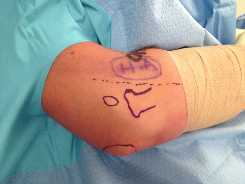 Lateral epicondylitis | The Bone School