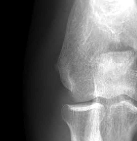 Lateral Epicondylitis / Tennis Elbow | The Bone School