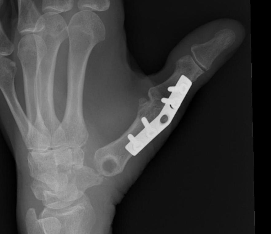 Rheumatoid Thumb | The Bone School