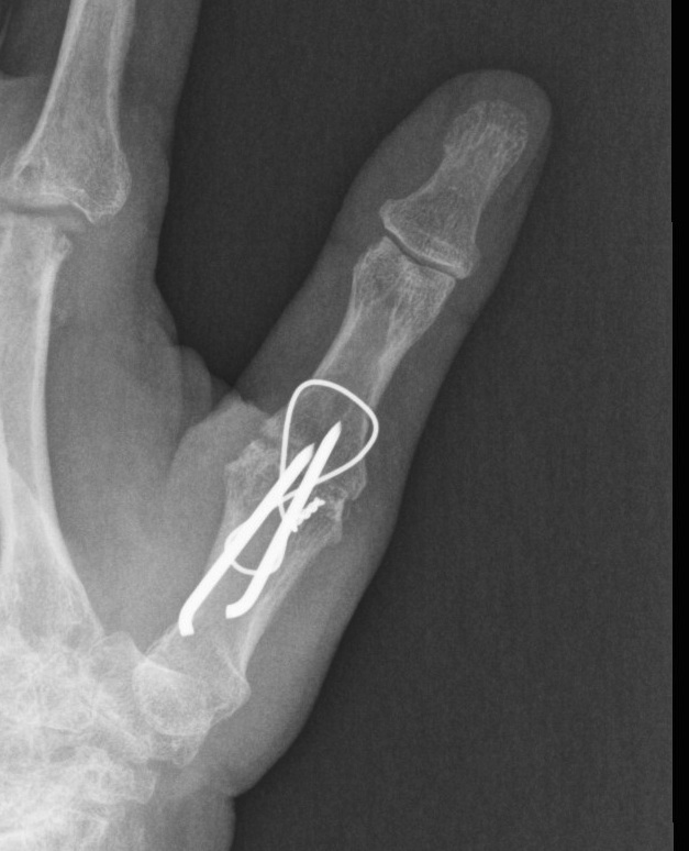 Rheumatoid Thumb | The Bone School