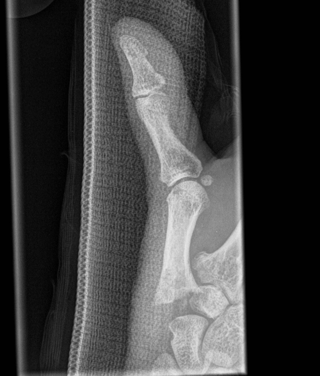 Base of Thumb OA | The Bone School