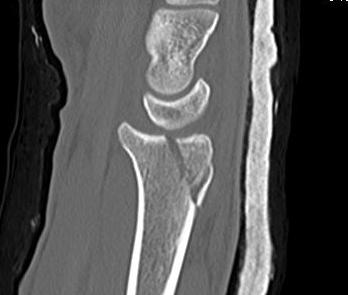 Barton Fracture