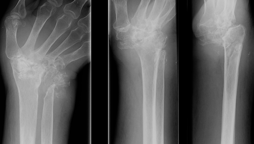 Gout | The Bone School