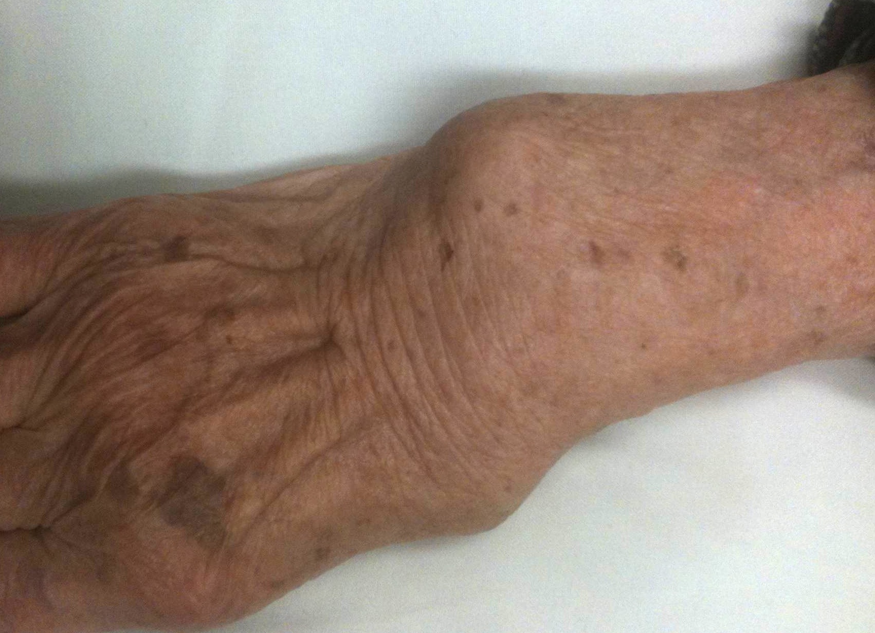 Rheumatoid Wrist | The Bone School