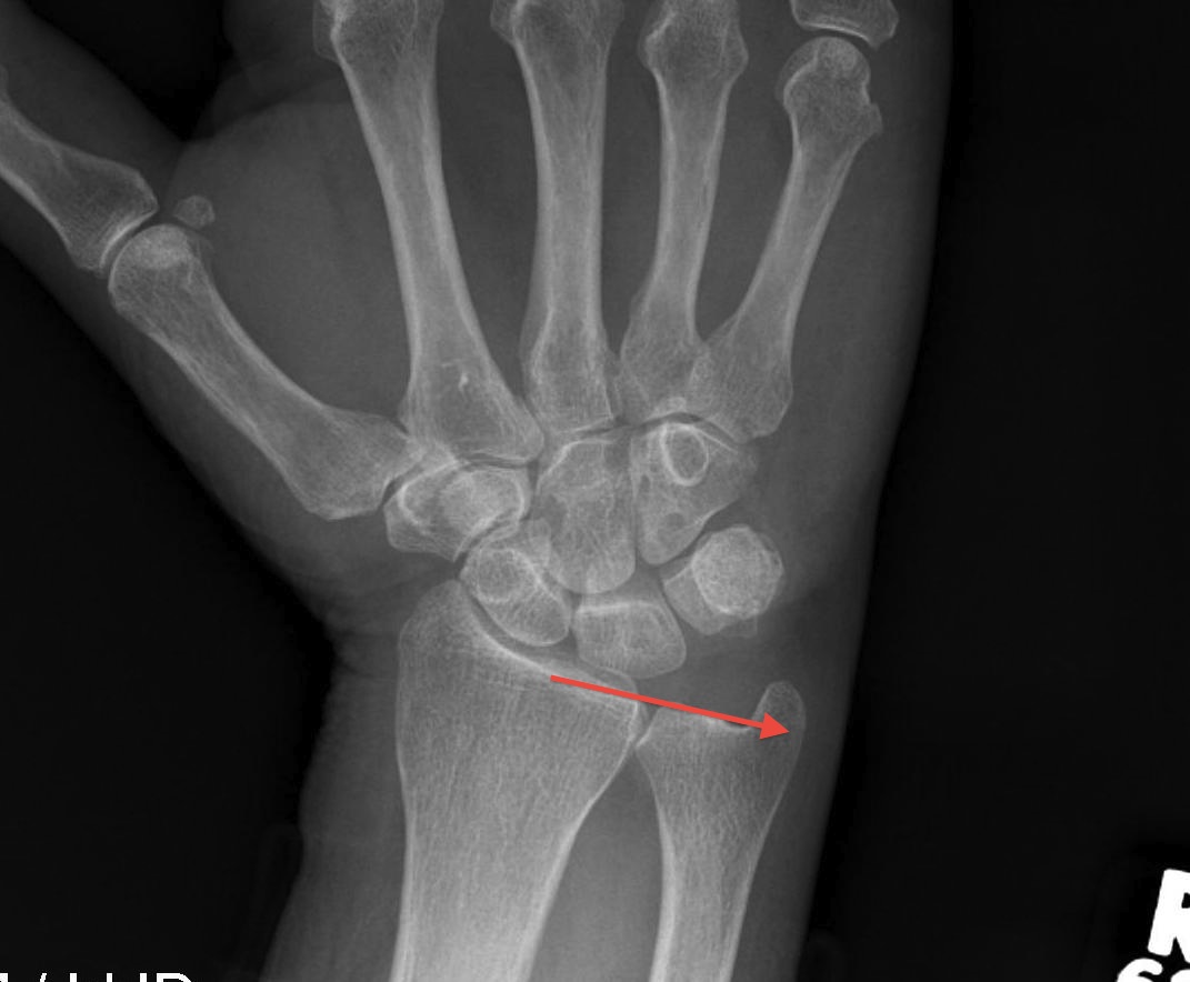 TFCC Tears | The Bone School